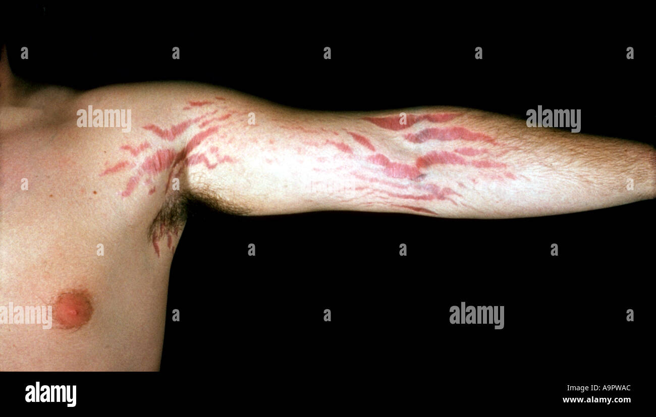 Purple striae Cushings syndrome Stock Photo - Alamy