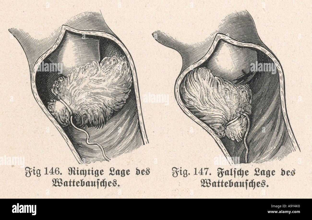 Contraception method hi-res stock photography and images - Alamy
