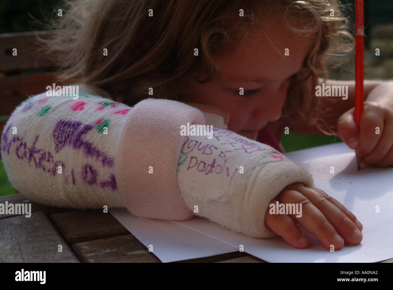 Little girl with a broken arm Stock Photo - Alamy