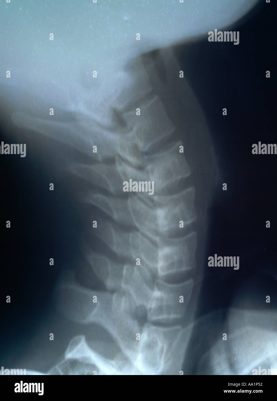 Spinal cord injury xray hi-res stock photography and images - Alamy