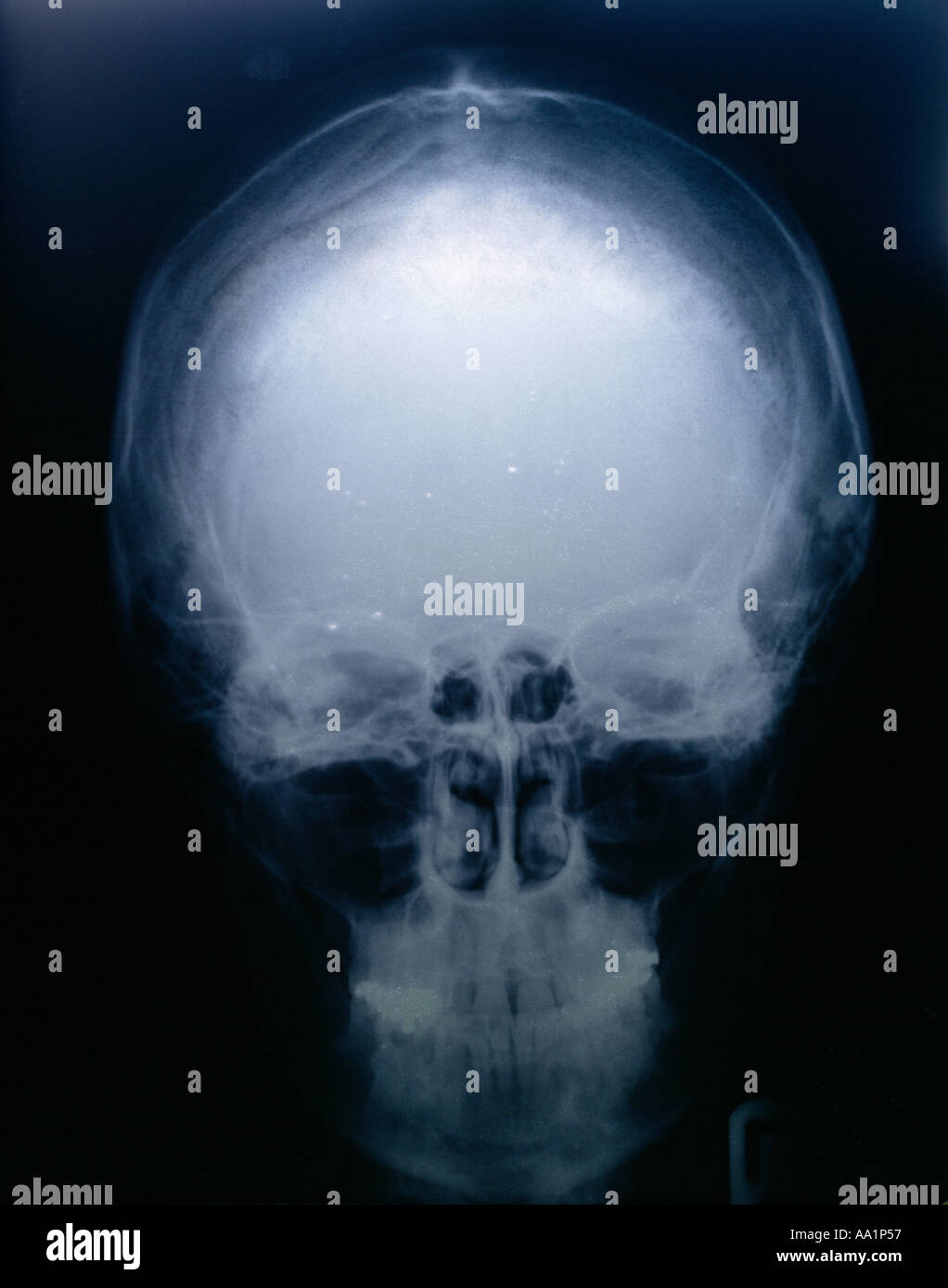 Fracture forehead hi-res stock photography and images - Alamy