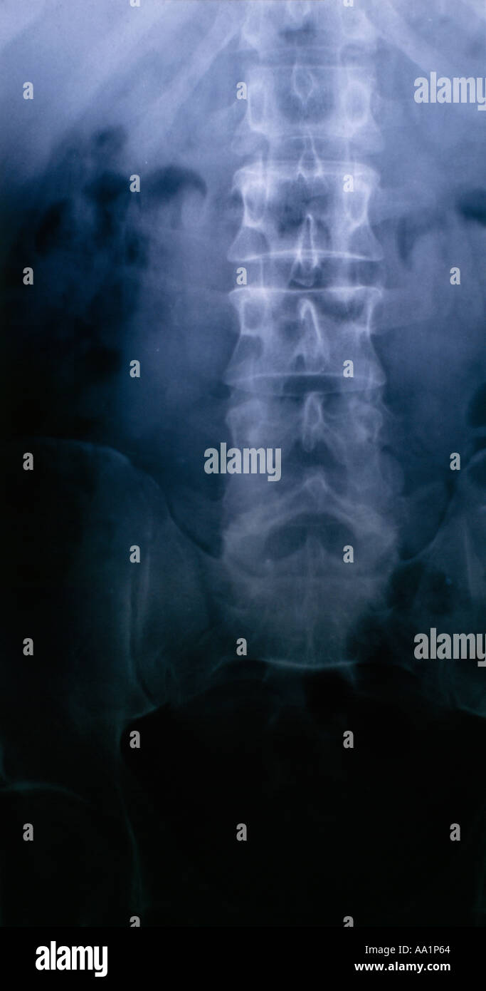 xray, bone, injury, injuries Stock Photo - Alamy