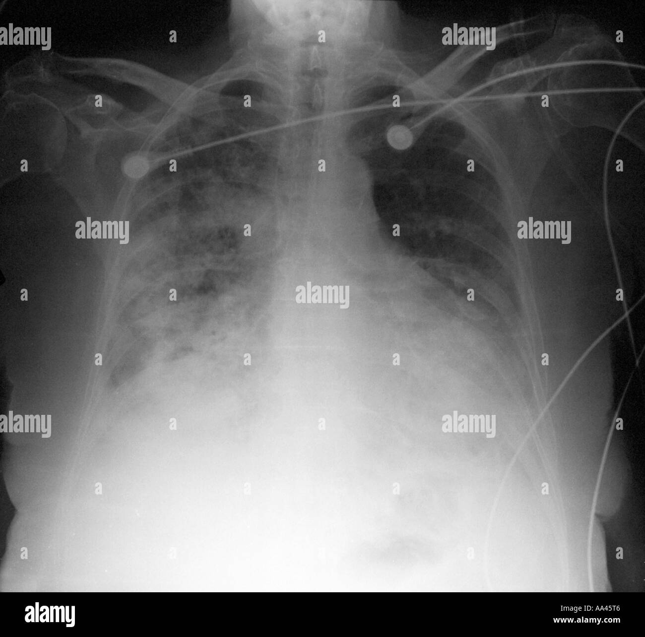 CXR congestive heart failure 77 year old woman Stock Photo - Alamy