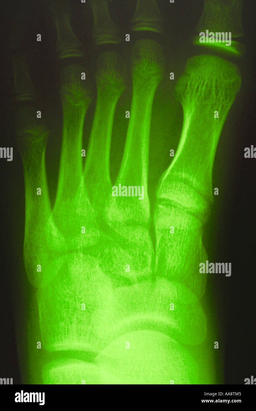 Right Foot X Ray High Resolution Stock Photography and Images - Alamy