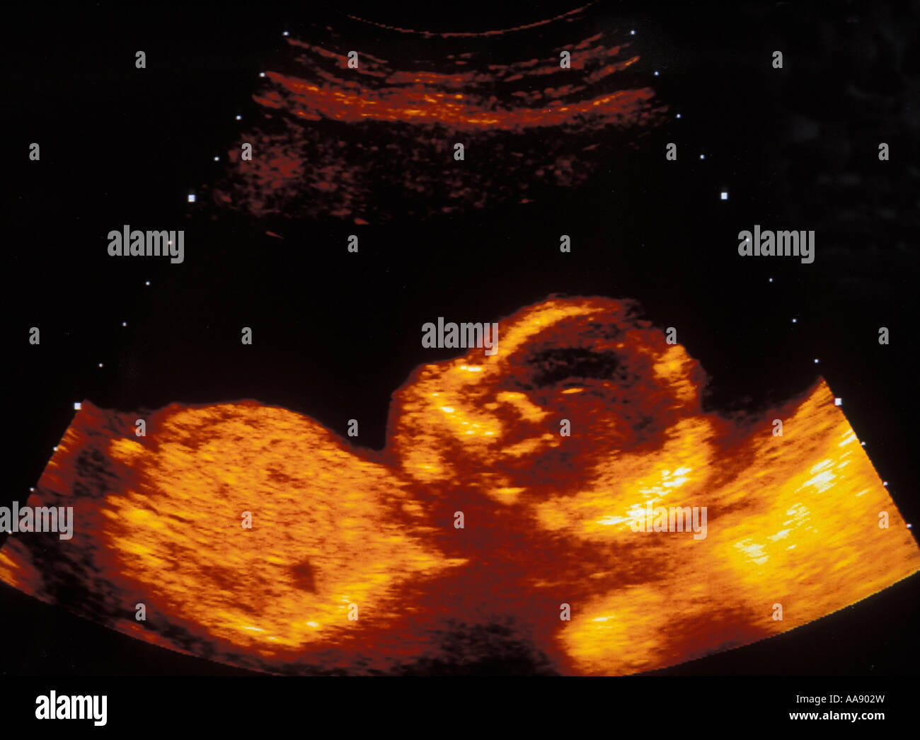 Sonogram taken at 6 months since conception The subject is a male and ...