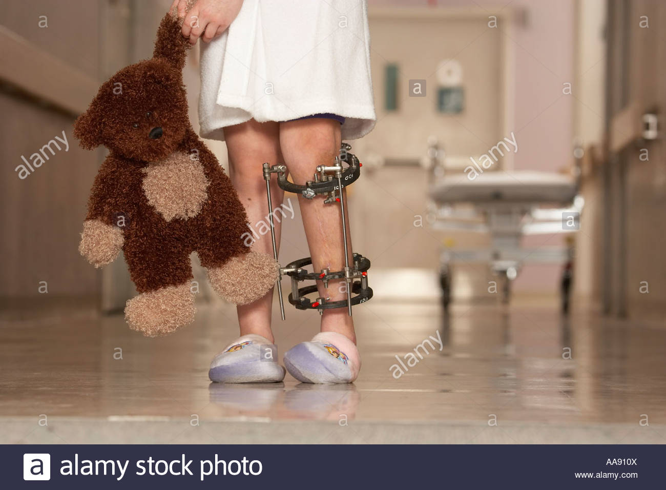 Why Do Babies Wear Leg Braces at Rocio Wilds blog