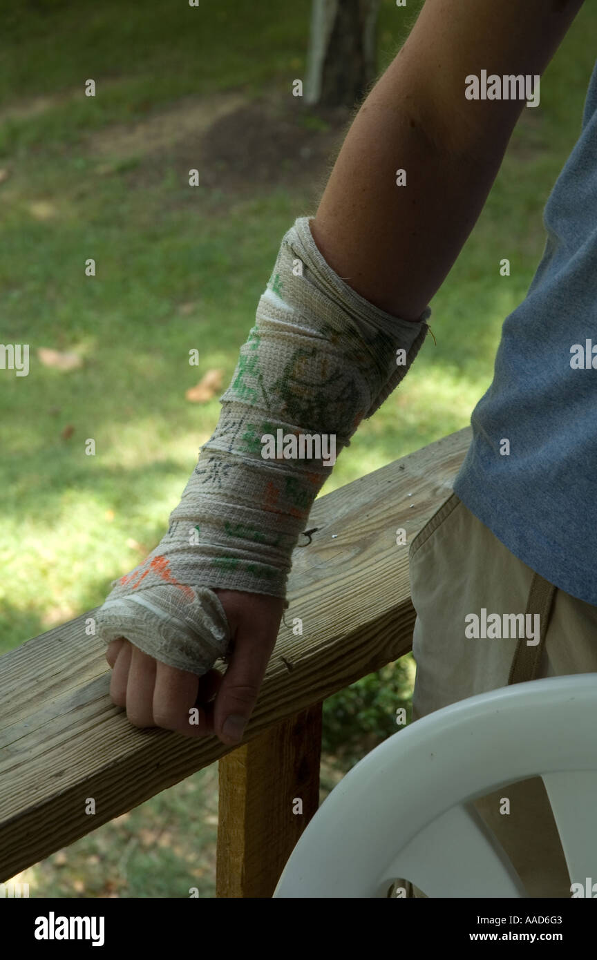 Arm & Hand in Cast Stock Photo - Alamy