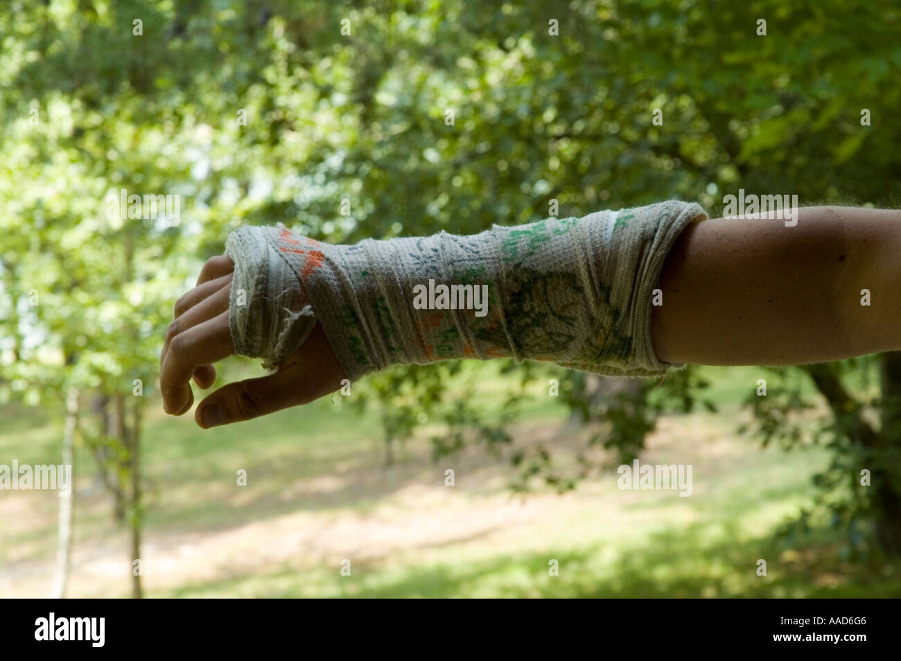 Arm & Hand in Cast Stock Photo - Alamy