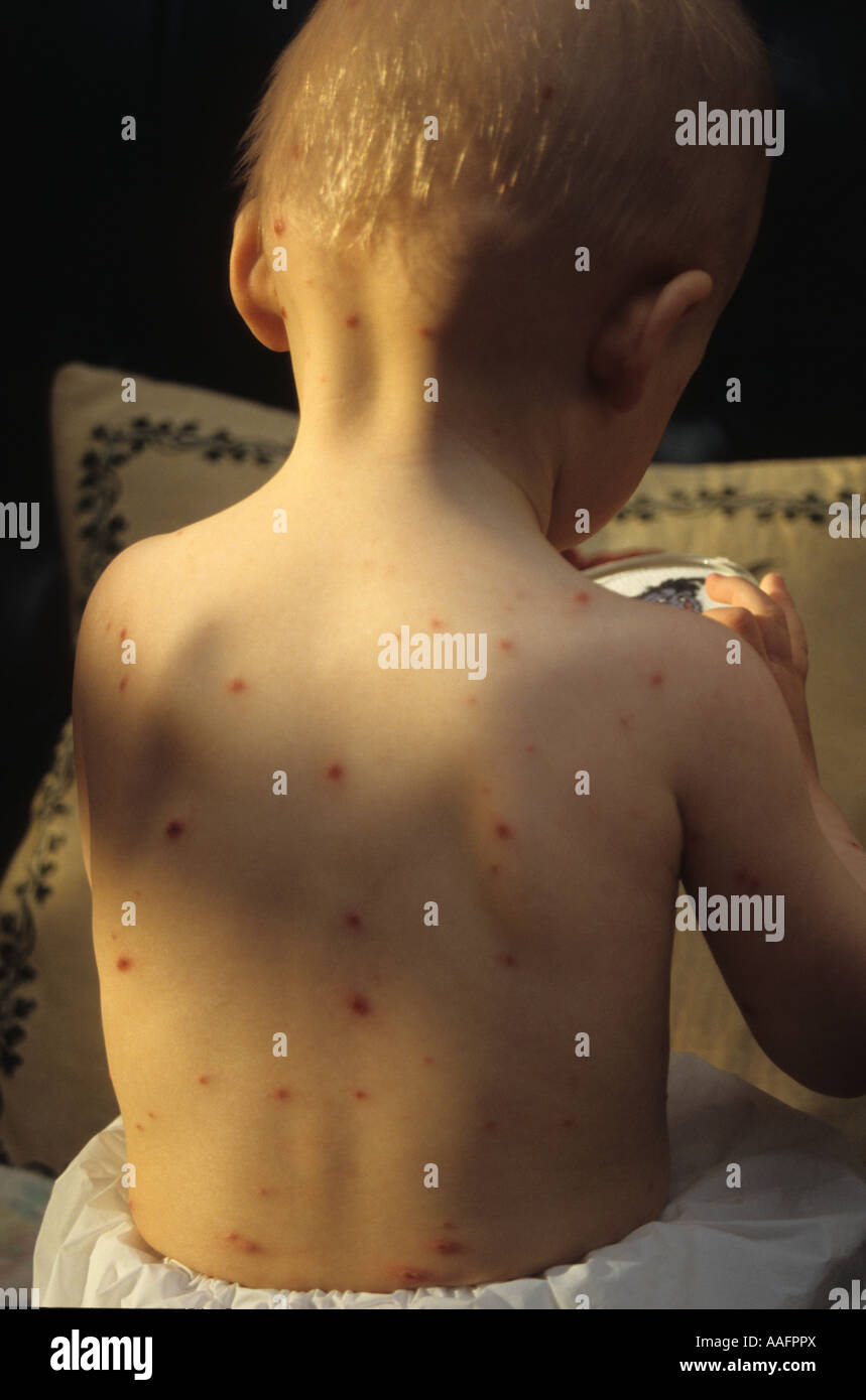 Baby with chicken pox hi-res stock photography and images - Alamy