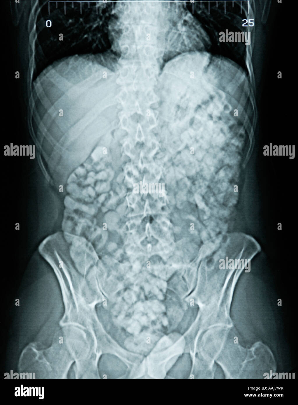 Osteoclasis hi-res stock photography and images - Alamy