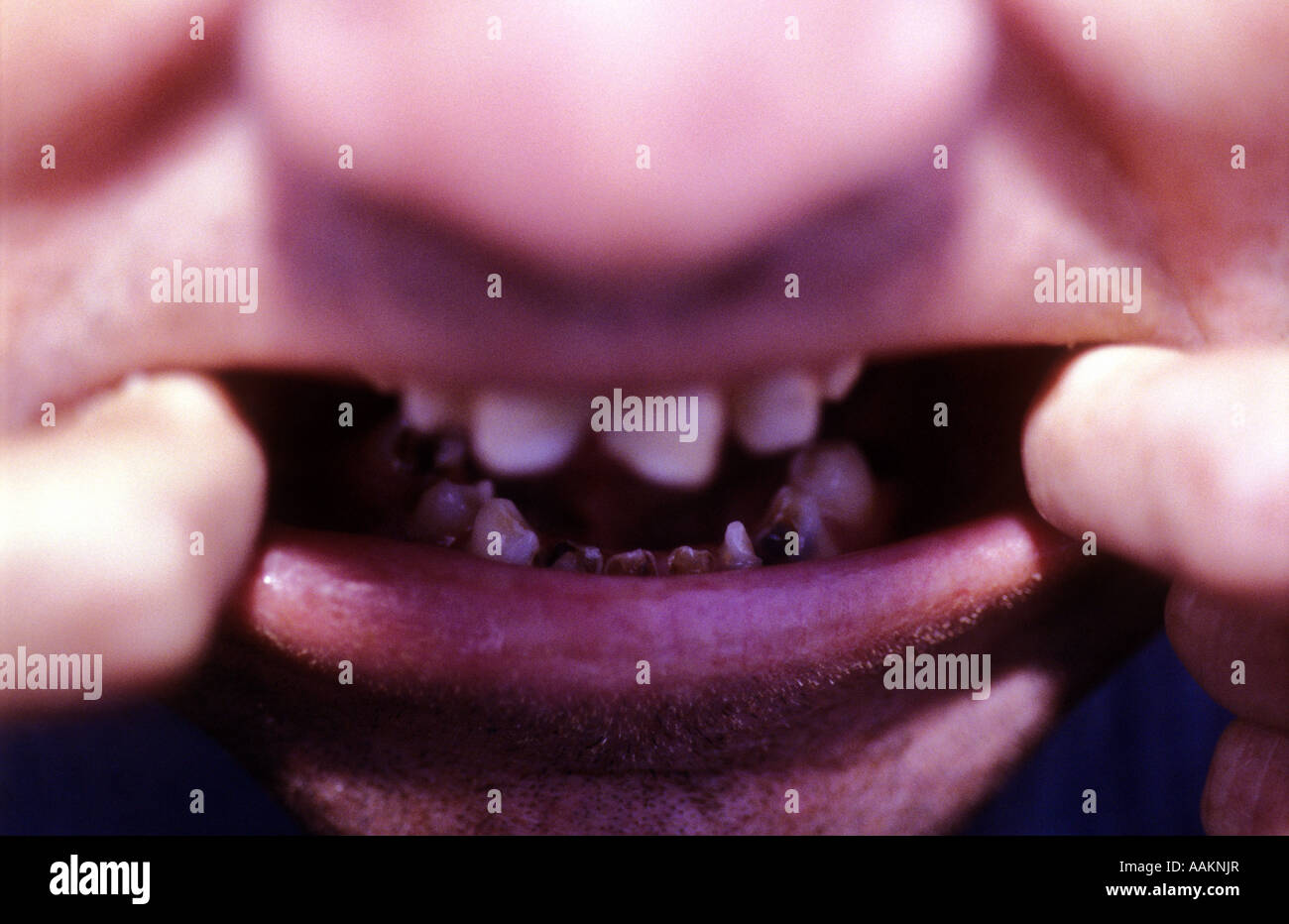 Decaying tooth hi-res stock photography and images - Alamy