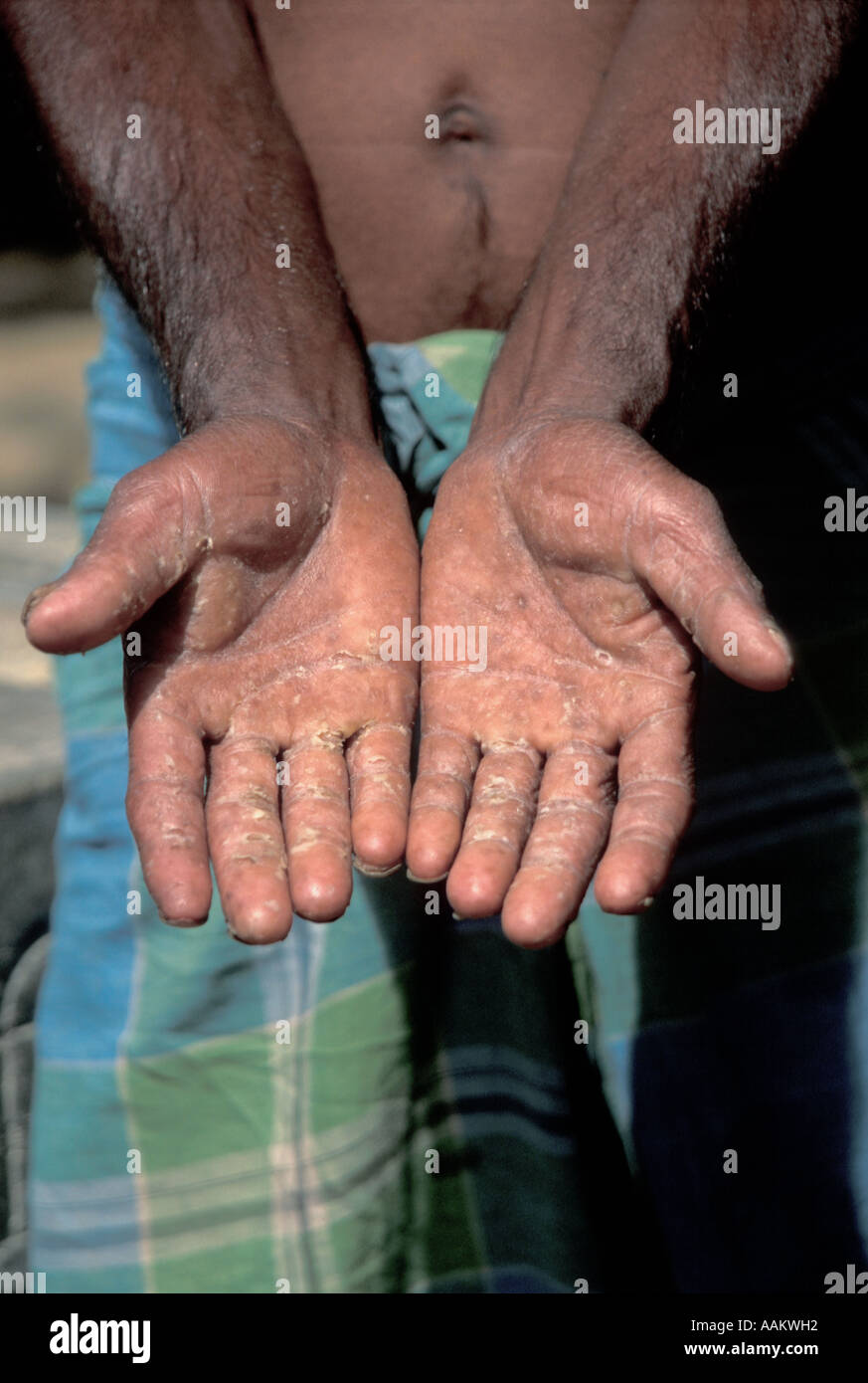 Arsenic poisoning hi-res stock photography and images - Alamy