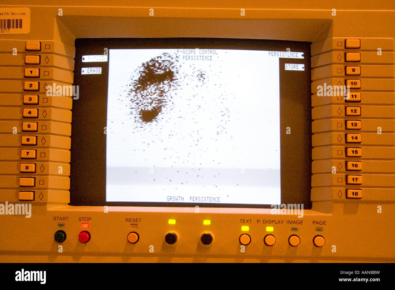 Screen showing results for gallbladder duct test with HIDA and nuclear ...
