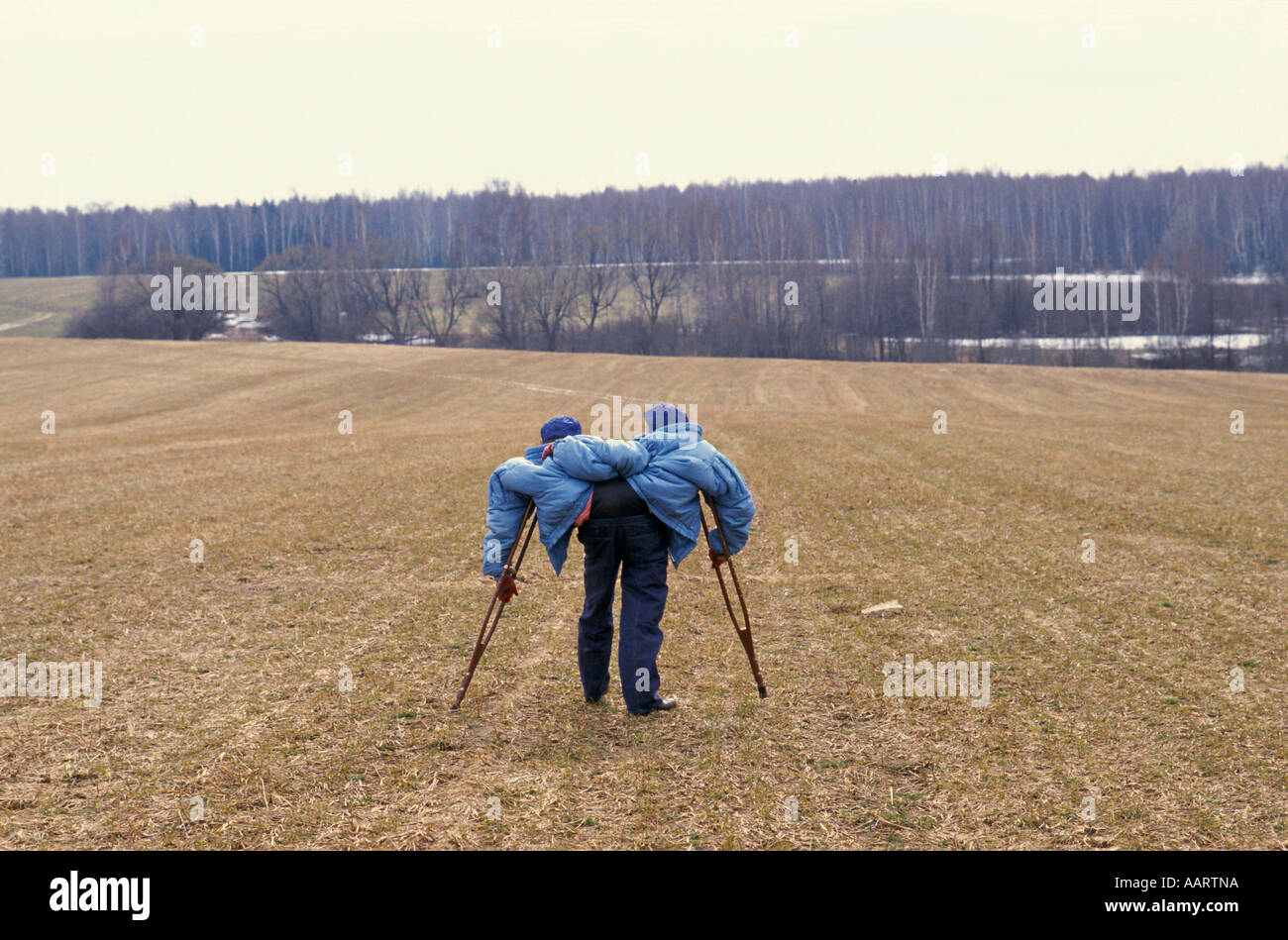 Russian conjoined twins Masha and Dasha Krivoshlyapova in Moscow Stock ...