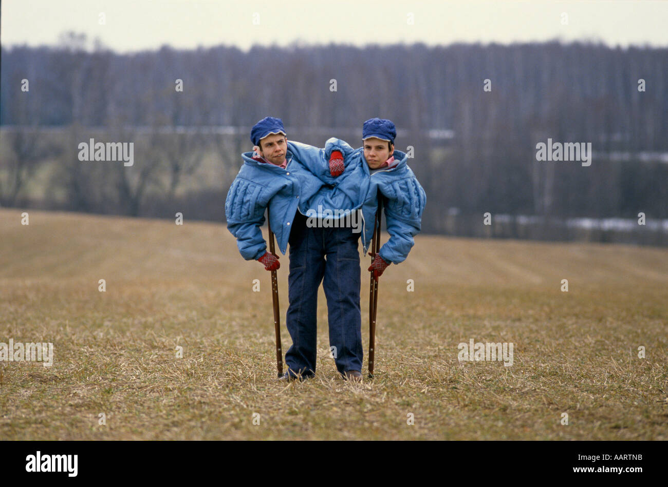 Russian conjoined twins Masha and Dasha Krivoshlyapova in Moscow Stock ...
