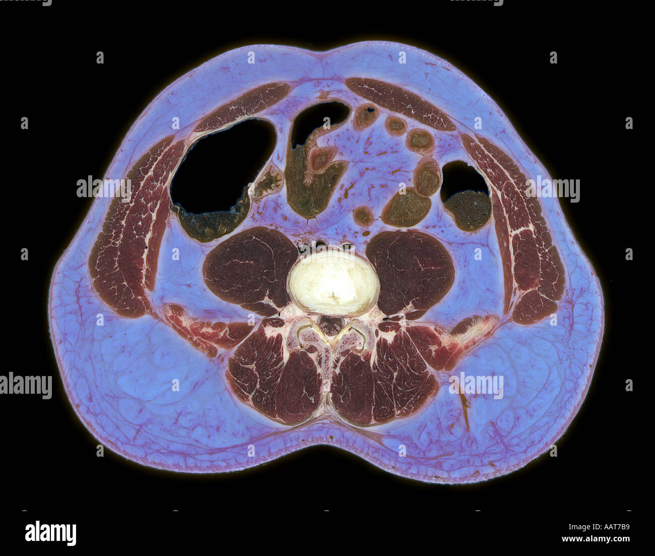 section through the abdomen of an overweight male showing a large ...