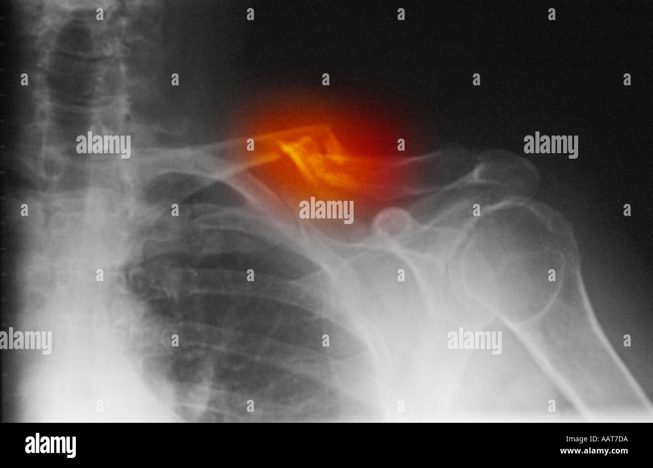 comminuted clavicle collarbone fracture Stock Photo - Alamy