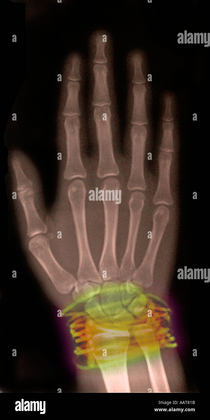 hand xray of a 10 year old girl wearing bracelets Stock Photo - Alamy
