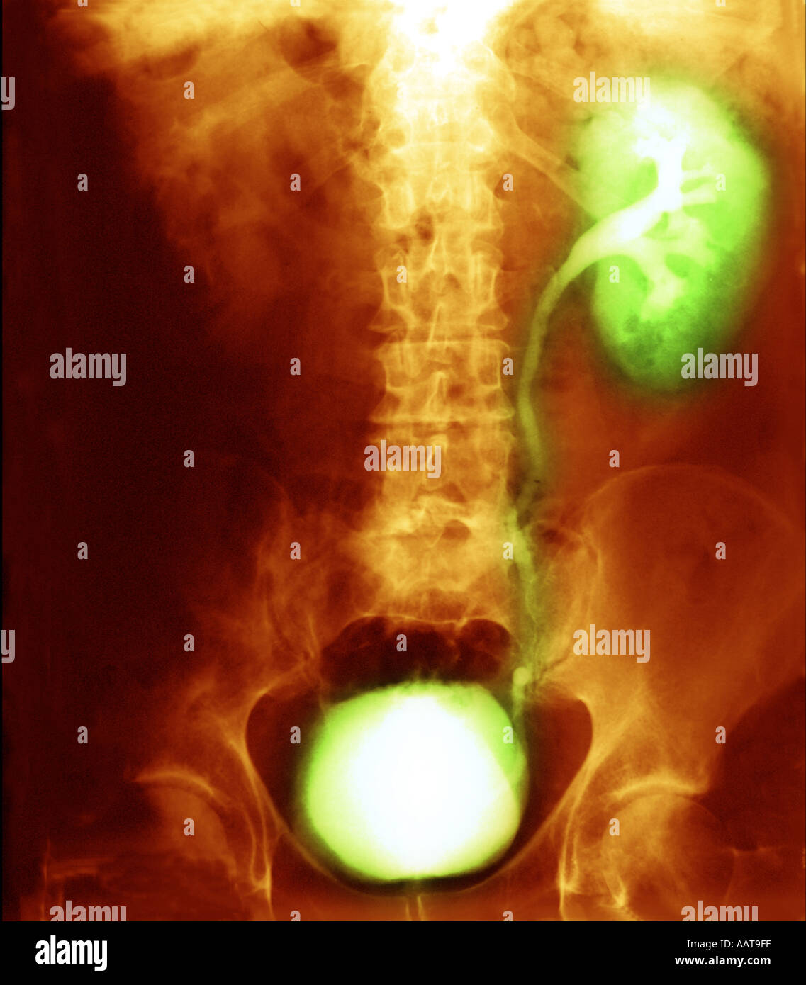 abdomen xray showing bladder and kidney Stock Photo - Alamy