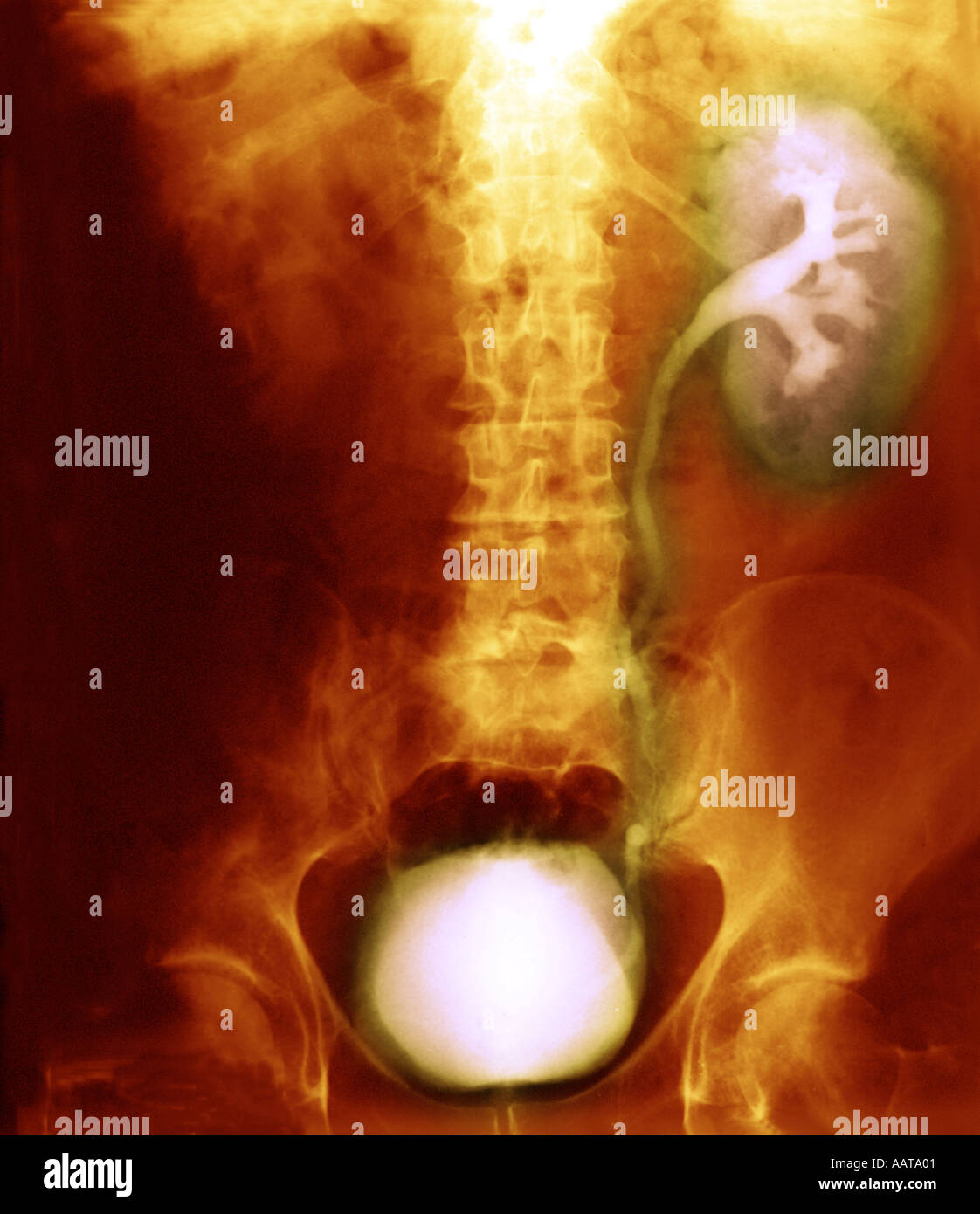 Xray of bladder hi-res stock photography and images - Alamy