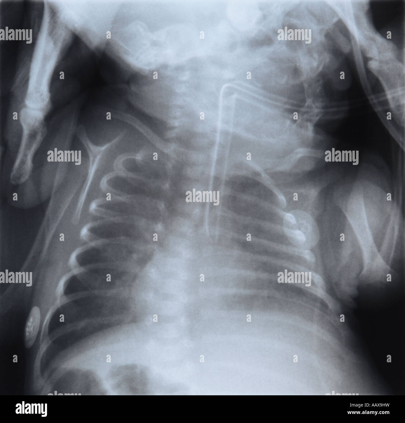 x-ray of a baby Stock Photo - Alamy