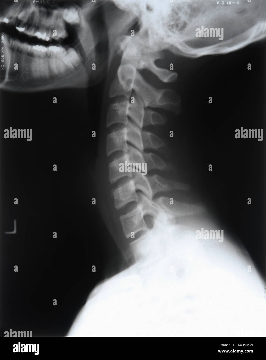 Broken neck x ray hi-res stock photography and images - Alamy