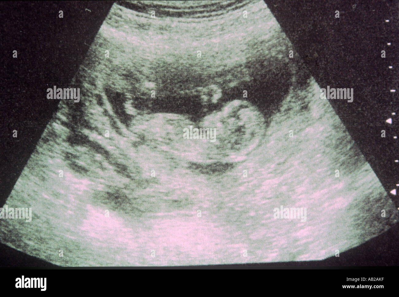 Ultrasound Scan of Female Foetus in Womb Health Lifestyle Wales Stock ...