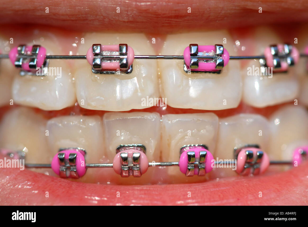 Colourful braces hi-res stock photography and images - Alamy