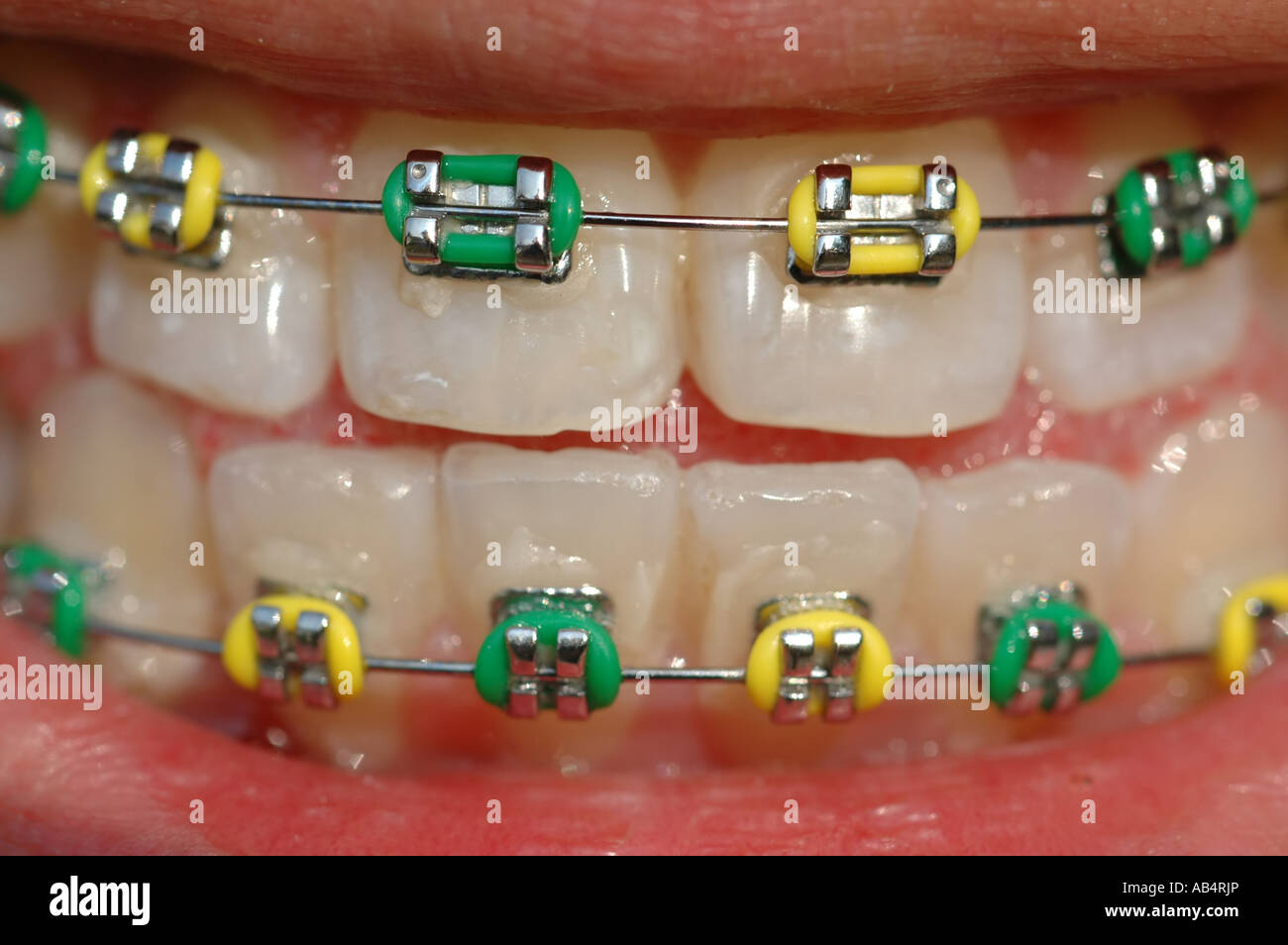 Colourful braces hi-res stock photography and images - Alamy