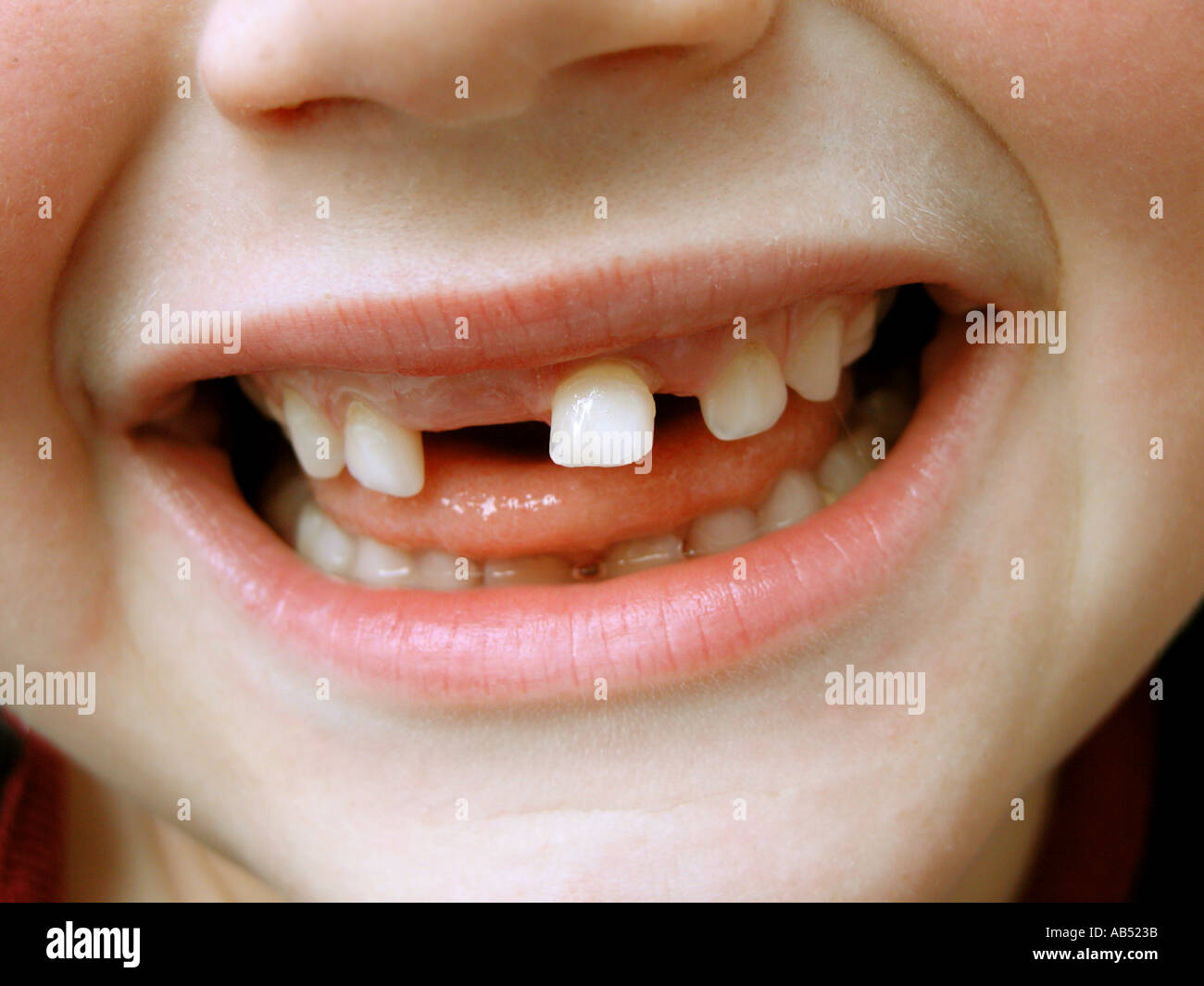 seven 7 year old boy loses first front tooth milkteeth gap Stock Photo ...