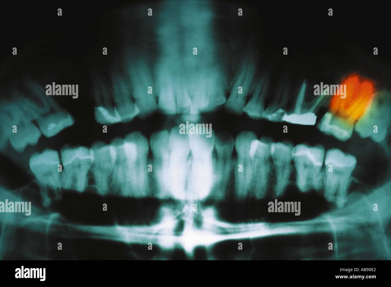 Teeth x rays xrays hi-res stock photography and images - Alamy