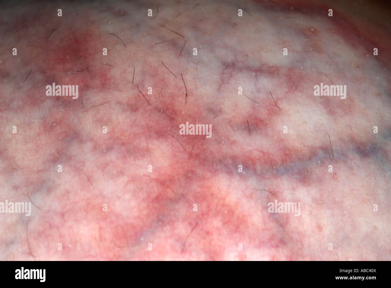 Skin tissue cancerous cells hi-res stock photography and images - Alamy