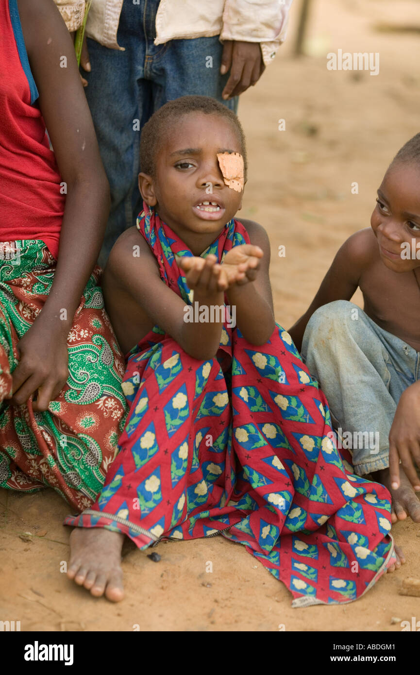 pygmy girl in a rainforest village with an injured eye, near Pokone in ...
