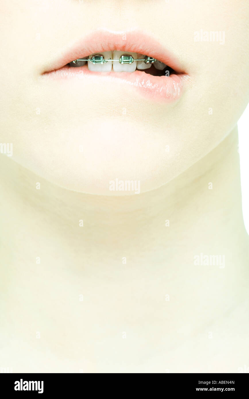 Teenage girl with braces biting lip, extreme close-up Stock Photo - Alamy