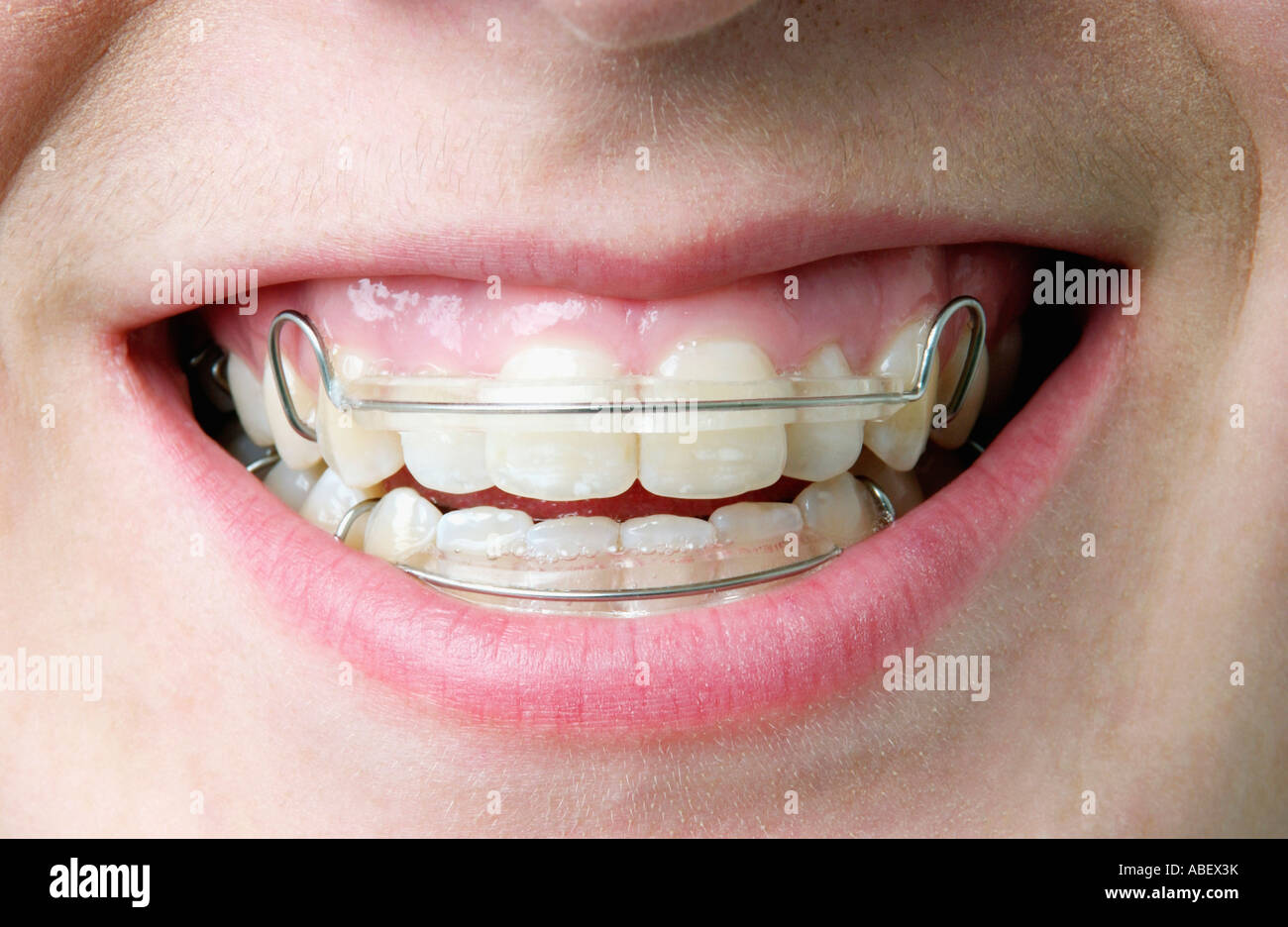 Retainer Retainer Orthodontic Stock Photos & Retainer Retainer ...