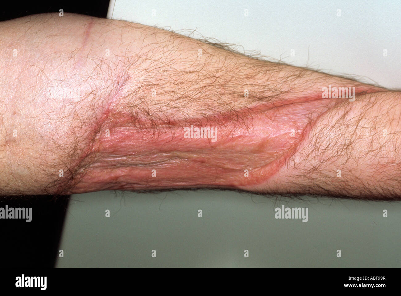 Industrial Vs Non Industrial Injury at Patrick Jefferson blog