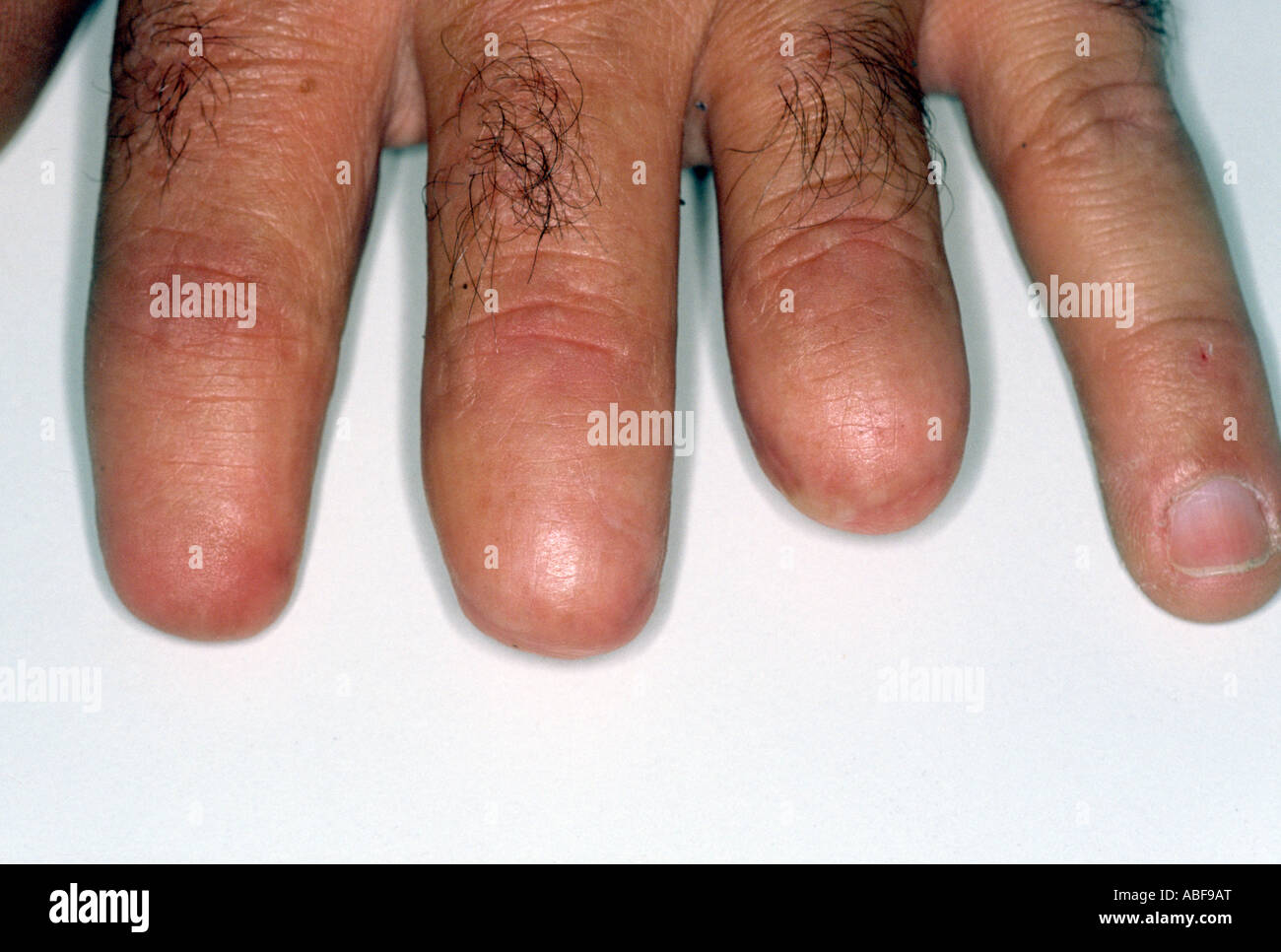 Mining Industrial Injury With Loss Of Part Of 3 Fingers Including The ...