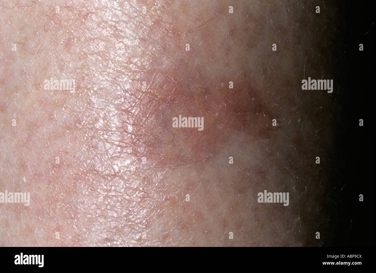 Lipoidica High Resolution Stock Photography and Images - Alamy