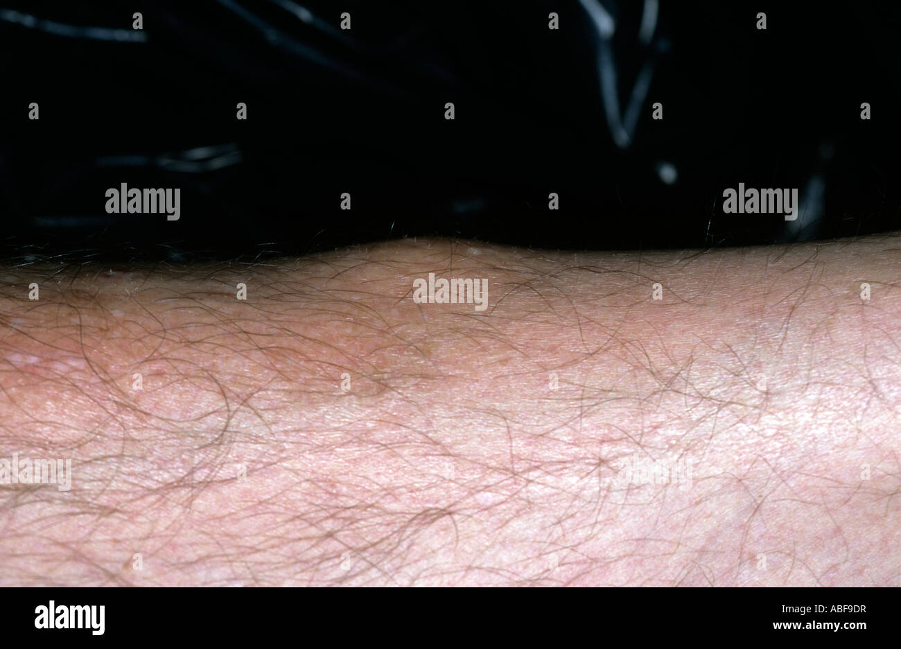 Nodule disease hi-res stock photography and images - Alamy