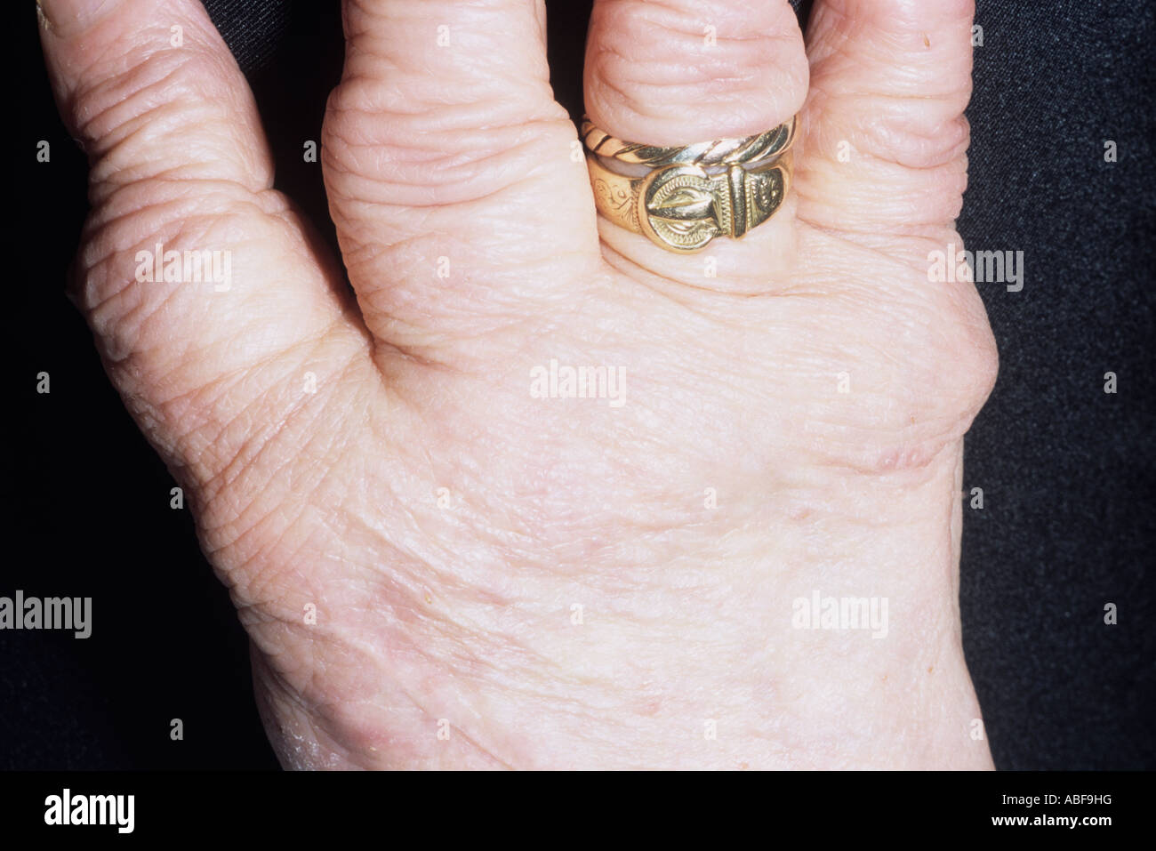 Hand deformity hi-res stock photography and images - Alamy