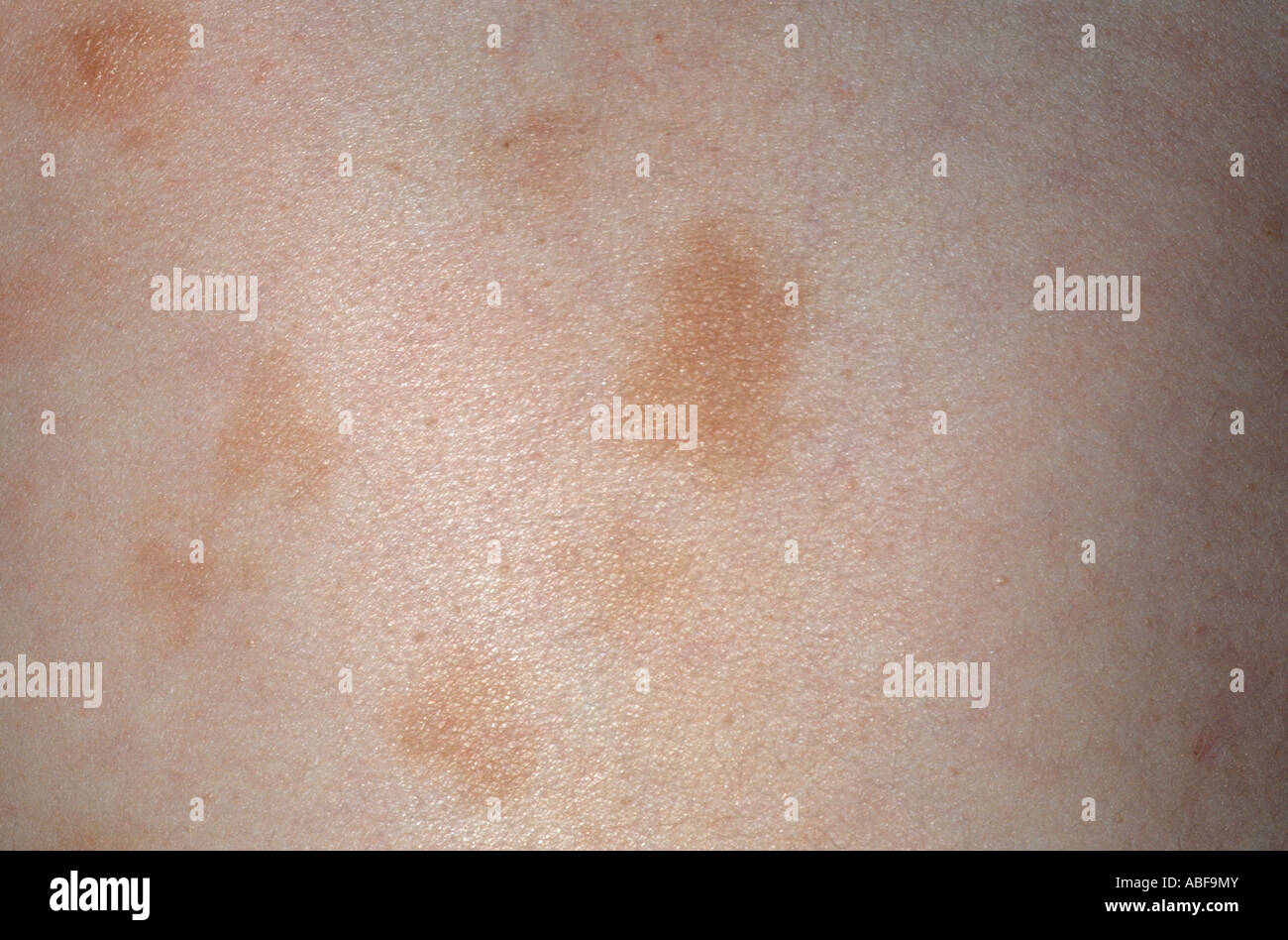 Lesions of juvenile mastocytosis- collections of mast cells -in the ...