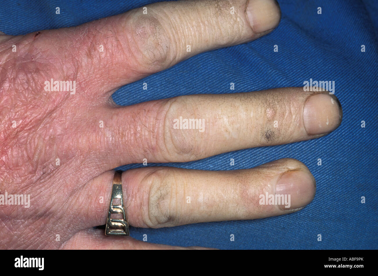 Raynauds phenomenon hi-res stock photography and images - Alamy