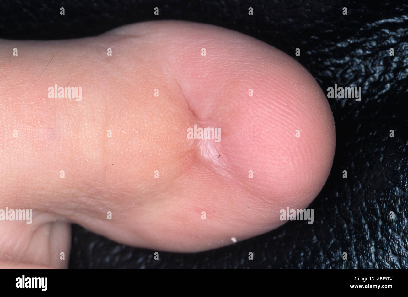 Ingrowing High Resolution Stock Photography and Images - Alamy