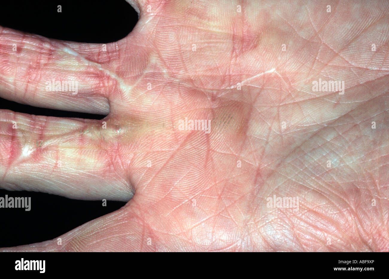 Hand Laceration Stock Photos & Hand Laceration Stock Images - Alamy
