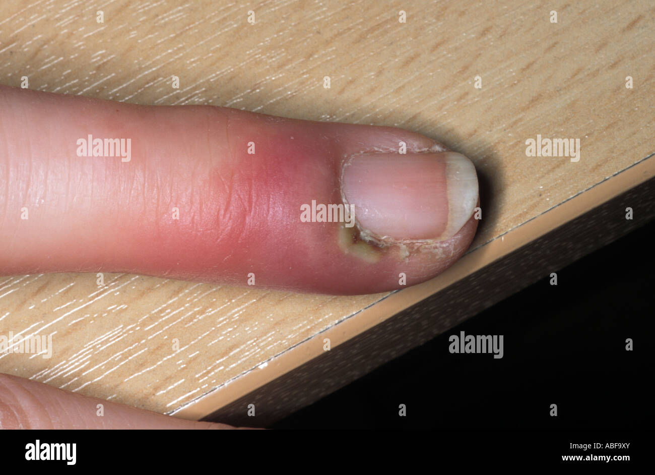 Bacterial Infection Stock Photos & Bacterial Infection Stock Images - Alamy