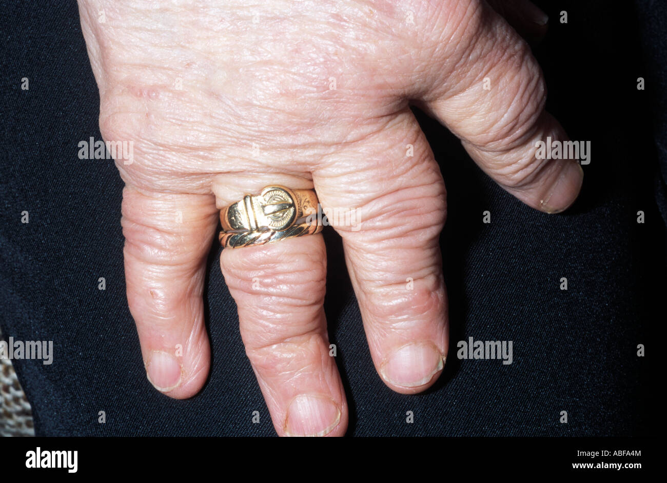 Interphalangeal dislocation hi-res stock photography and images - Alamy