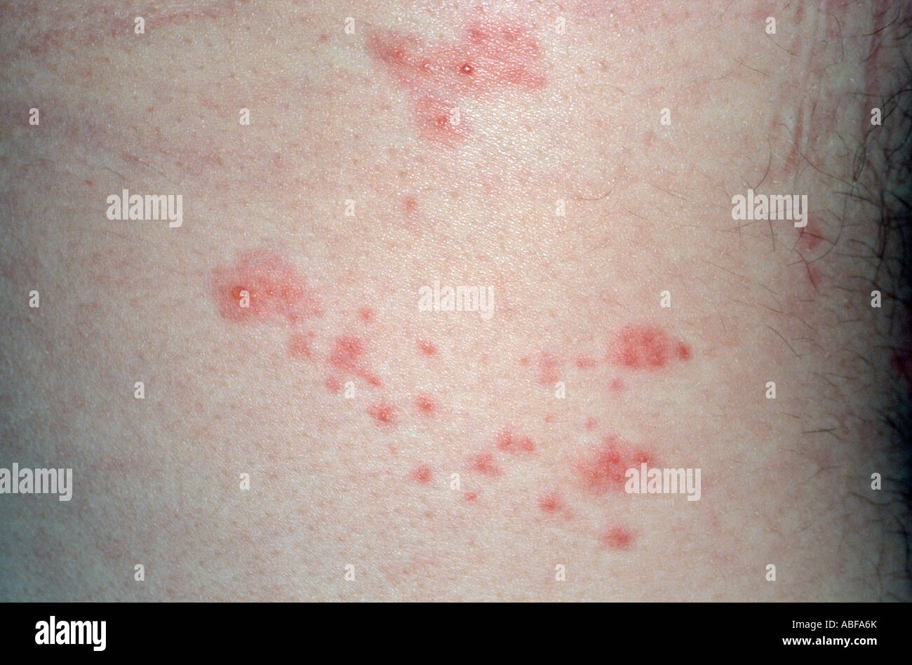 Shingles skin hi-res stock photography and images - Alamy