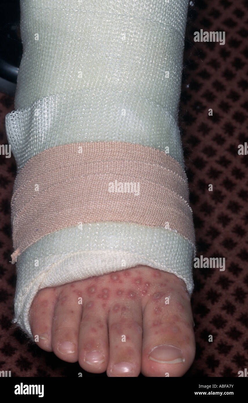 Foot plaster hi-res stock photography and images - Alamy