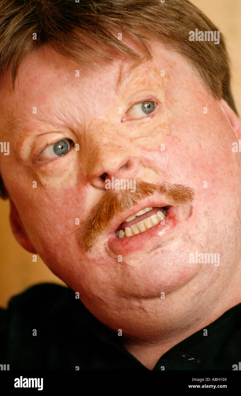 Simon Weston suffered terrible burns when RFA Sir Galahad was bombed ...