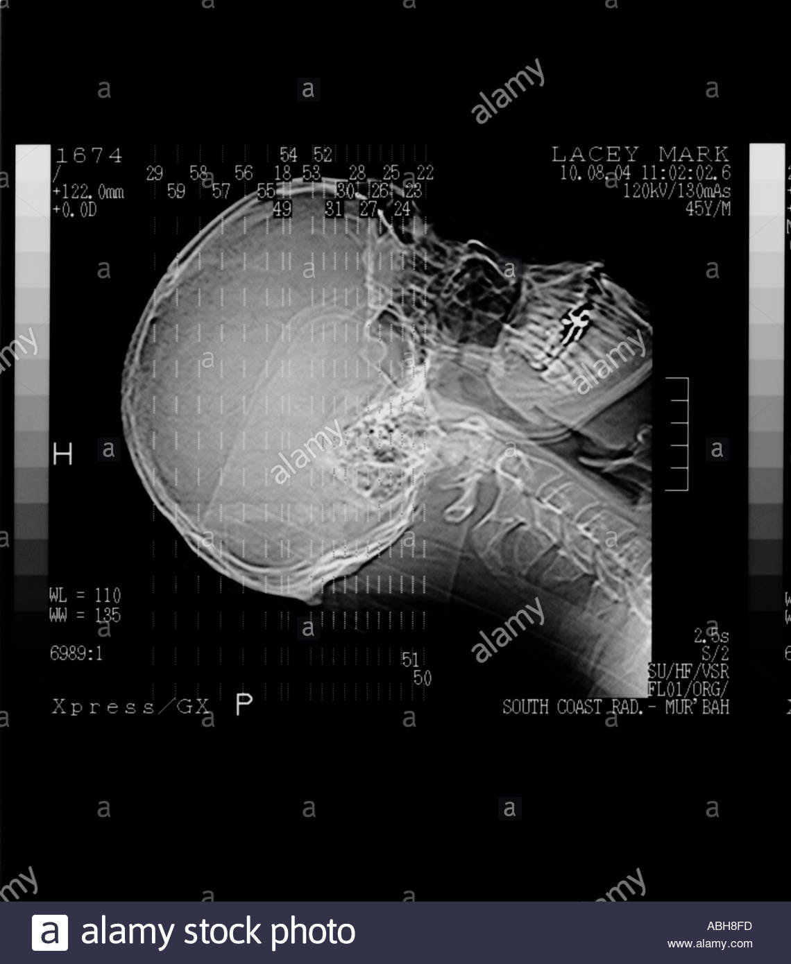 Bone cancer scan Black and White Stock Photos & Images - Alamy